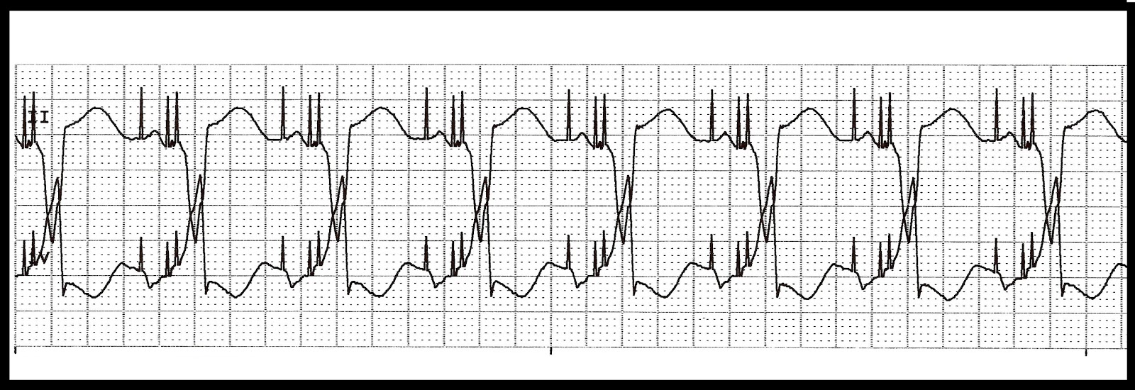 Basic EKG Rhythm Test 34