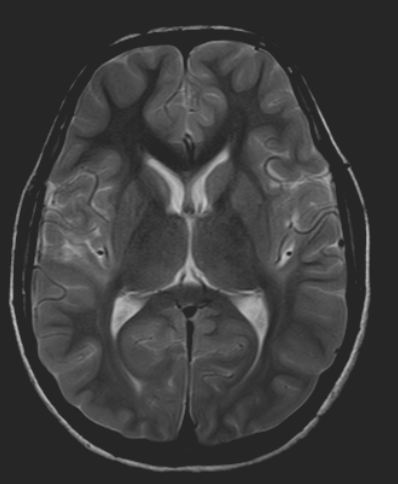 Opercular Syndrome-MRI - Sumer's Radiology Blog