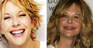 Meg Ryan Plastic Surgery Before and After Facelift and Botox - Star ...