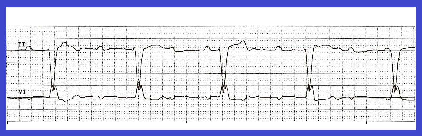 Practice EKG Strips 334