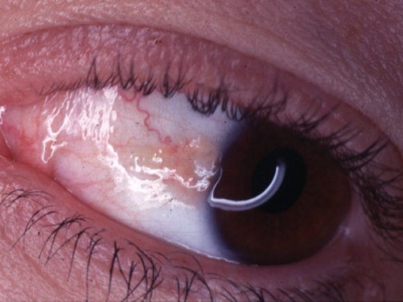 Diseases Treatment: Pinguecula Treatment