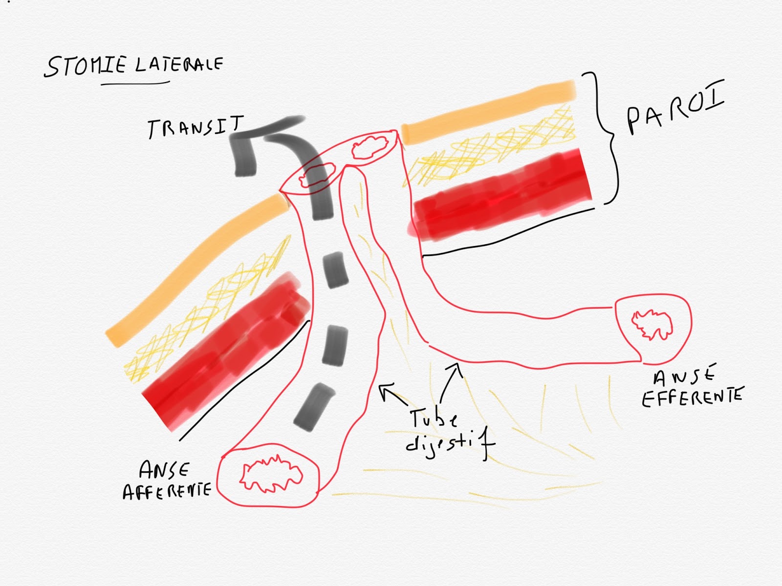 CHIRURGIE DIGESTIVE ET HEPATO-BILIAIRE: Stomies cutanées digestives