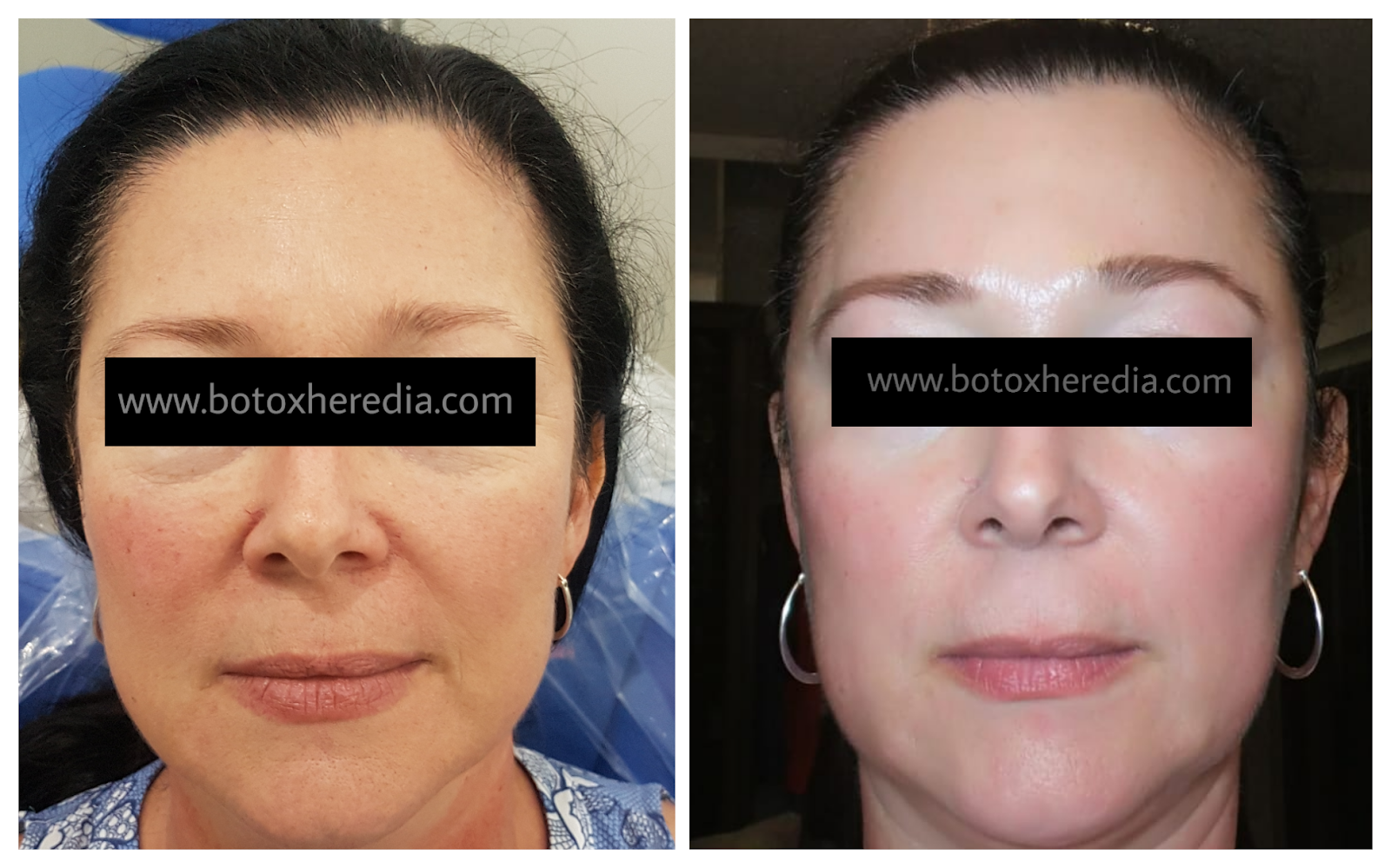 Botox, Acido Hialurónico, Bichectomia, Invisible Touch Hilos Pdo
