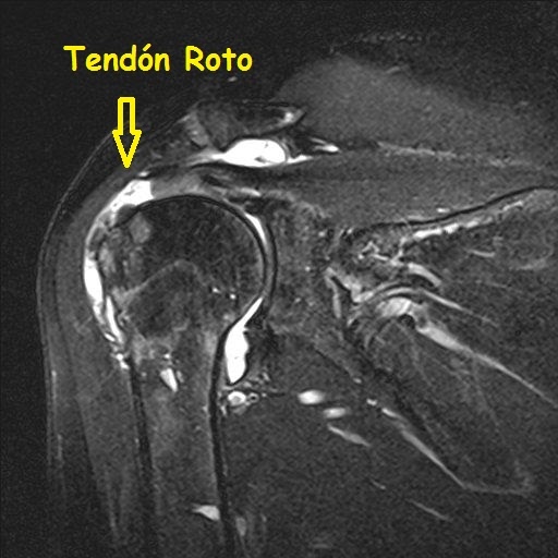 Patologías de hombro: Ruptura de tendon supraespinoso