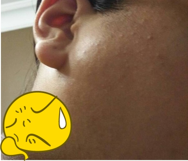 Petua Mengubati Penyakit Beguk Dengan Mudah