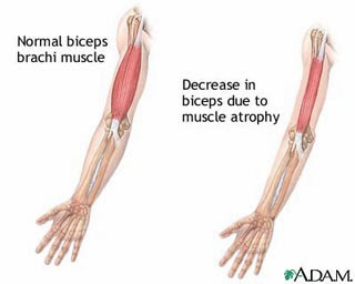 Anatomy and Physiology: Myotonia-Muscle