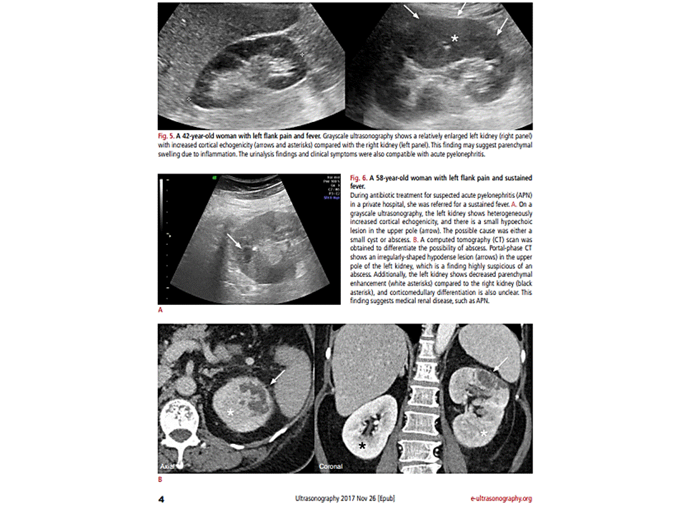 BÀI SOẠN VỀ SIÊU ÂM CHẨN ĐOÁN: Acute Flank Pain: Renal Stones and Acute ...