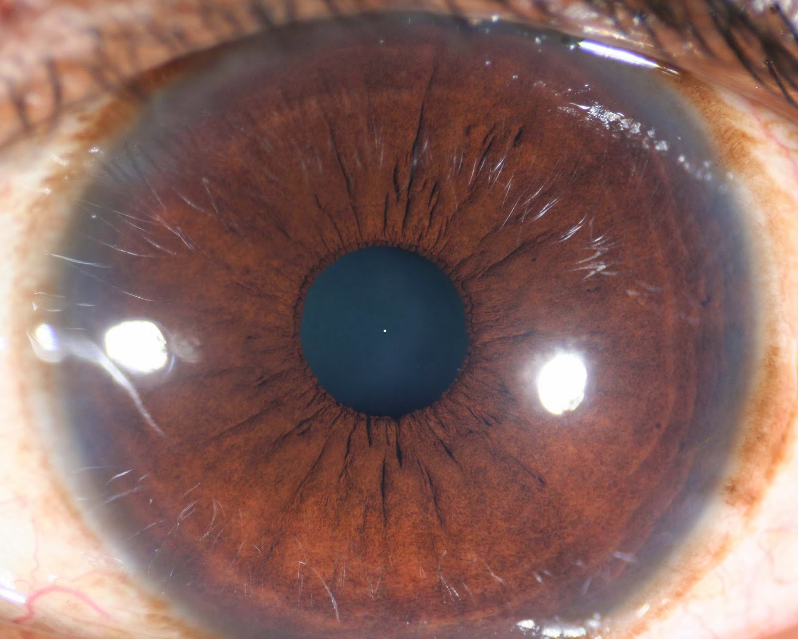 Modern & Multidimensional Iridology: IPB Morphologies, Pupil Flattening ...