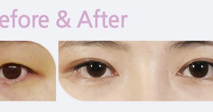 BK Plastic Surgery: ADVANCED EXPERTISE IN EYE SURGERY; BK OUTER CORNER ...