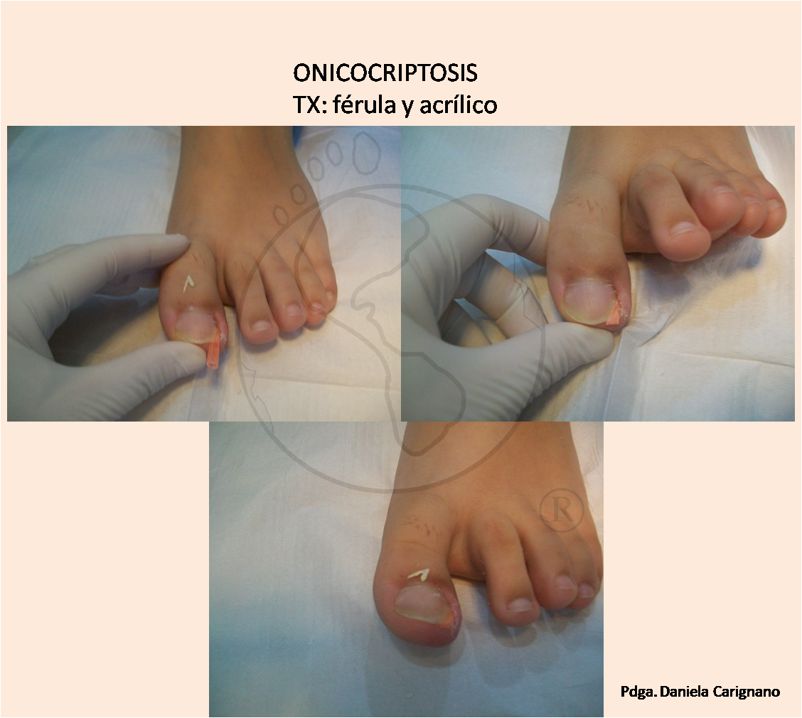 PODOLOGIA: LOS PIES SOBRE LA TIERRA #homeconsultingroom: ONICOCRIPTOSIS ...