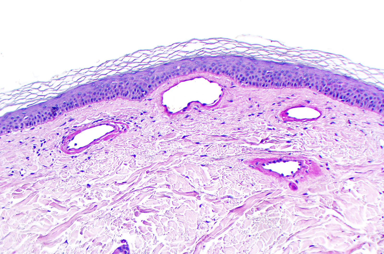 VIRTUAL GRAND ROUNDS IN DERMATOLOGY 2.0: Unusual Vascular Pattern