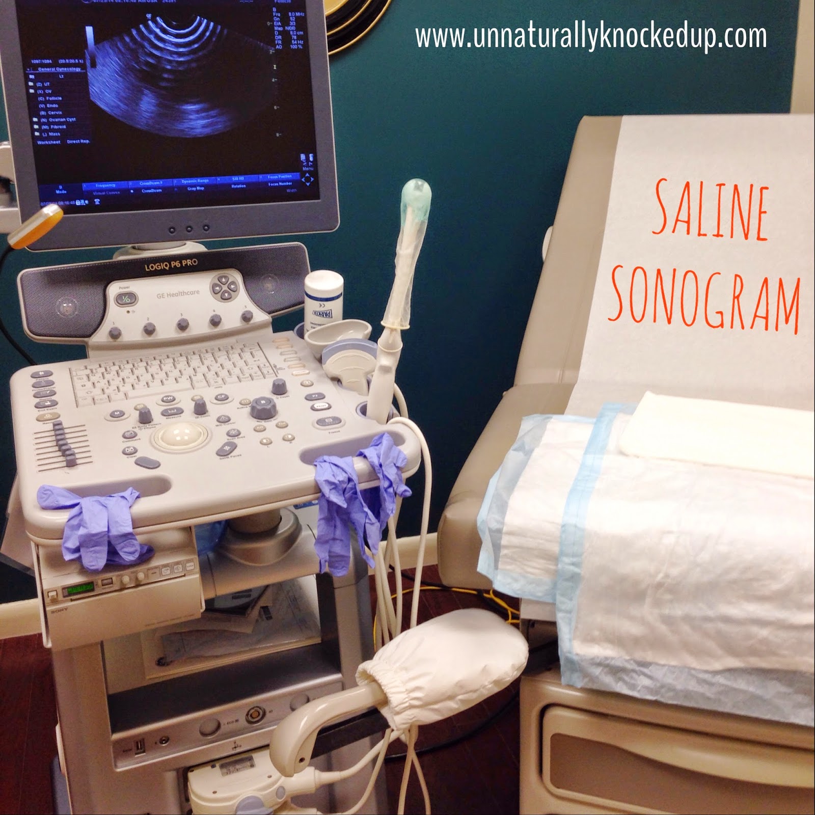 Unnaturally Knocked Up: Saline Sonogram - Cleared for FET!