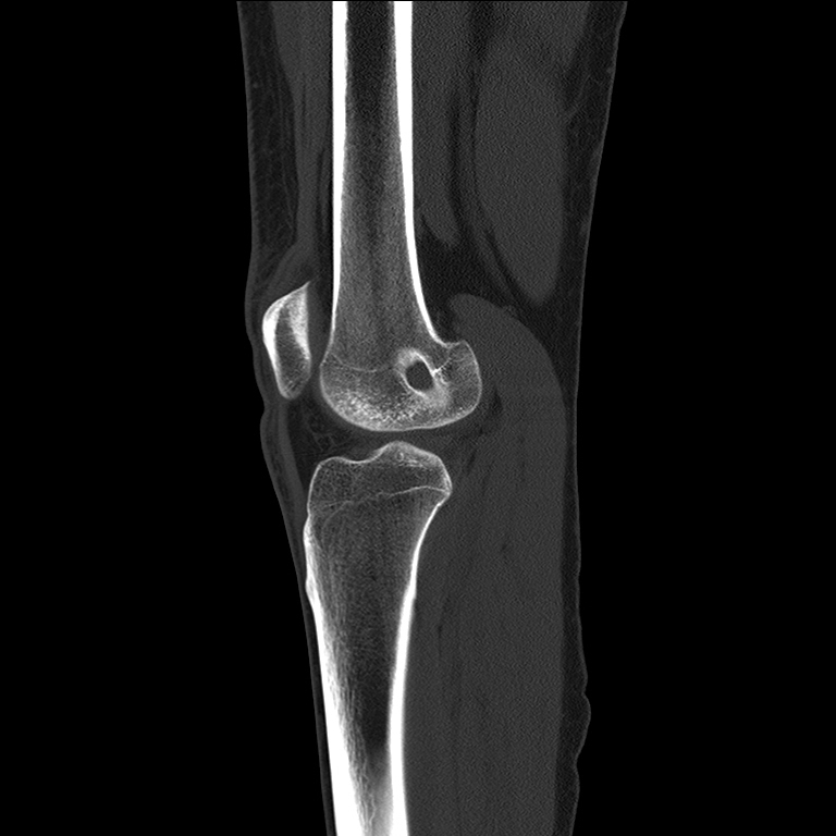 CT Knee - Radiology Imaging