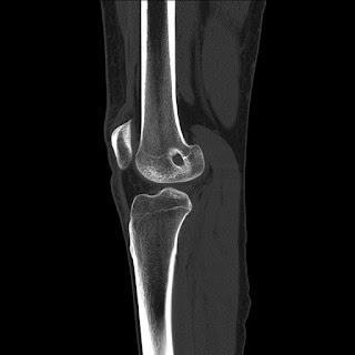 CT Knee - Radiology Imaging