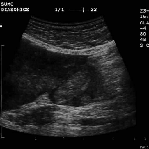 Doctor's knowledge: Gastric carcinoma with extensive liver metastasis.