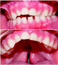 LOS TRASTORNOS DEL LENGUAJE : DISGLOSIA