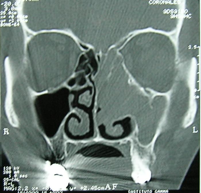Dr. Gustavo Hadad: PAPILOMA INVERTIDO - TUMOR NASAL