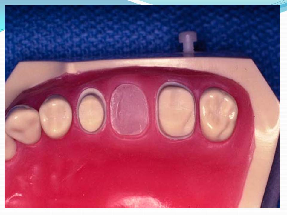 Dentistry: Introduction to Fixed Prosthodontics