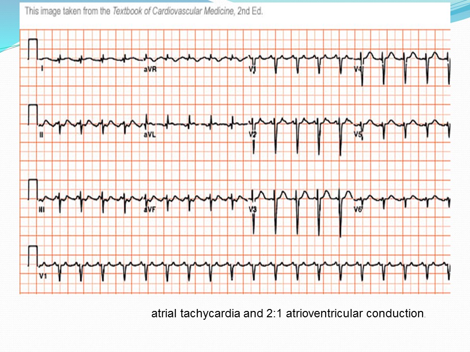 CVT Mohd Farid: Electrocardiogram ECG Part II Common Abnormalities Part I