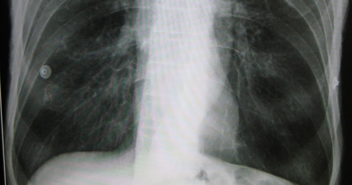 Emphyseme pulmonaire - Medecine & Maladie