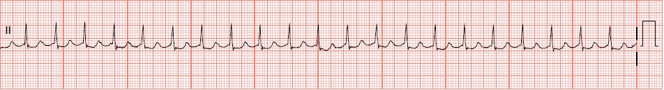 EKG Rhythm Strips 14: Junctional Rhythms