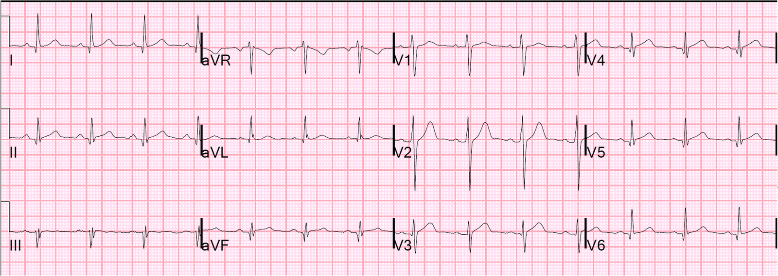 Dr. Smith's ECG Blog: Is this ACS? Look at the previous ECG!!