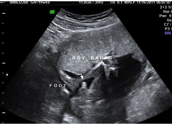 The Whaleys: 20 week anatomy scan