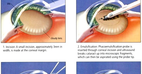 Ophthalmology Pocket Guide: Cataract Procedure