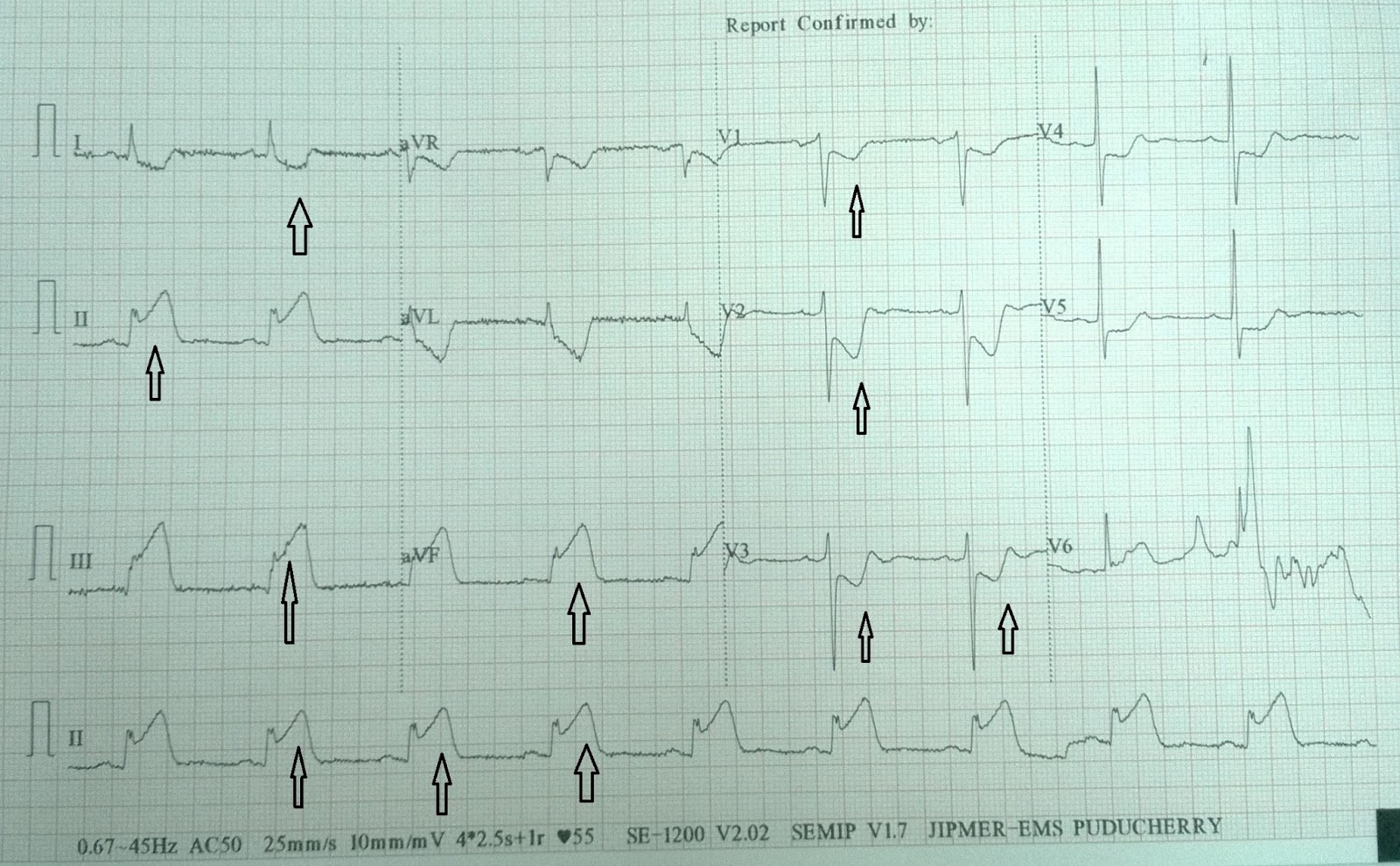 Cardiology window: IWMI with PWMI
