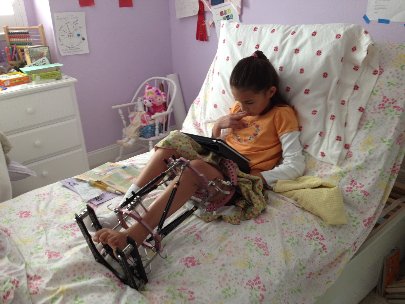 fibular hemimelia leg lengthening: Manipulation (Wiggle) Procedure