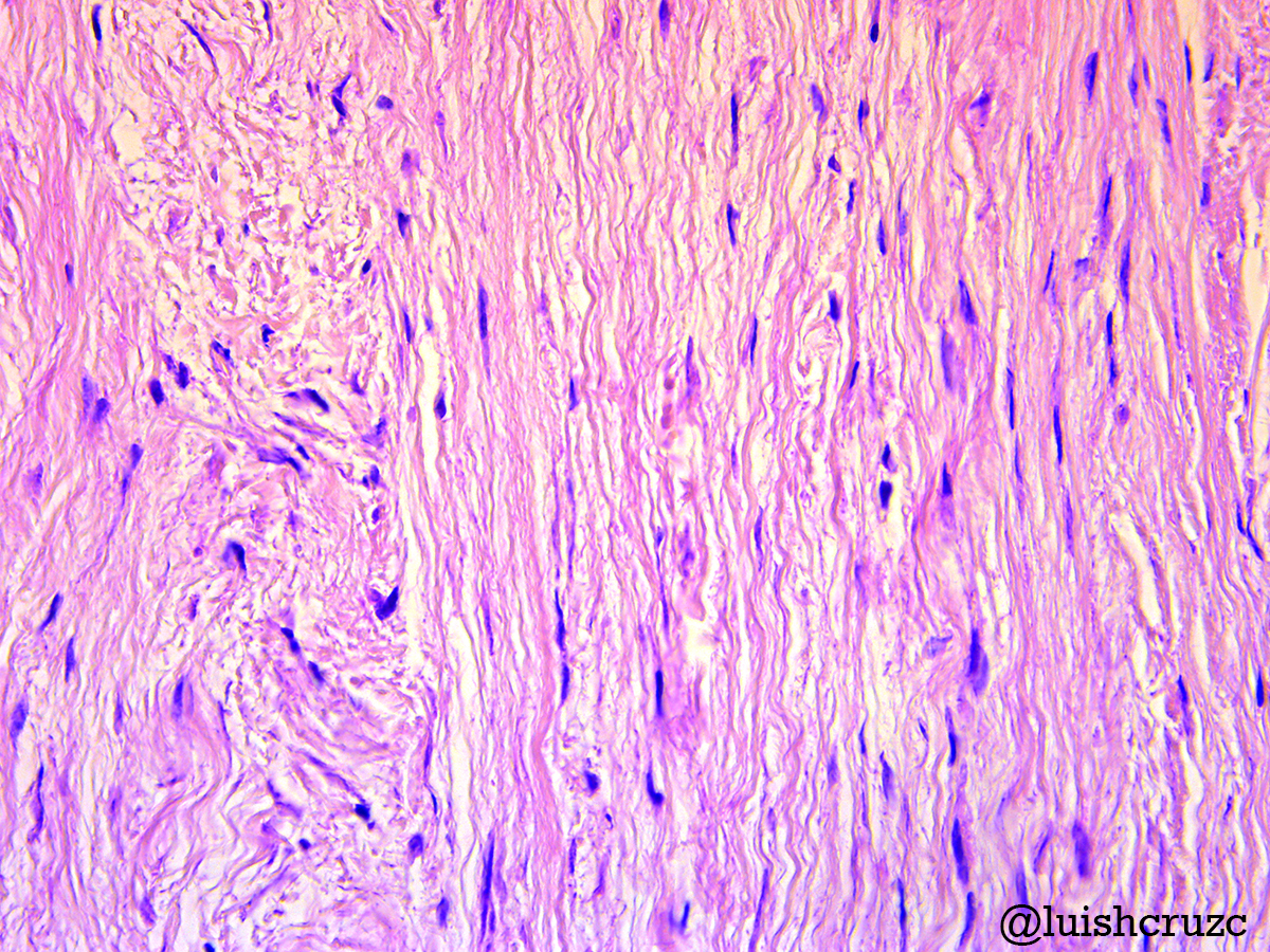 Patología CC: Miofibromatosis