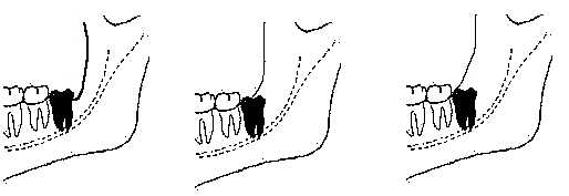 Odontologia : Dentes Inclusos: Terceiros Molares Inferiores