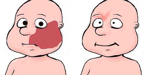 ¿QUÉ TIENE MI HIJO EN LA FRENTE? ¿MANCHA SALMÓN O MALFORMACION VASCULAR ...
