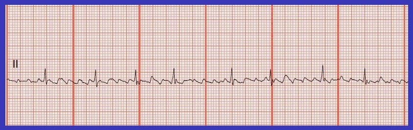 Ventricular Flutter Litfl Ecg Library Diagnosis