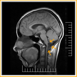 Cervicomedullary Exophytic Glioma - Sumer's Radiology Blog