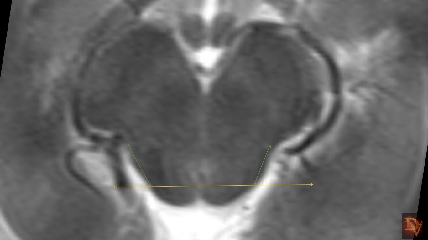 Ultimate Radiology : 'Hummingbird and Morning Glory' of Radiology