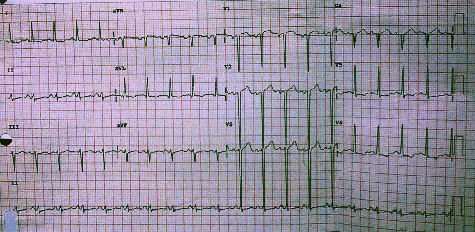 belajar membaca ekg: LVH