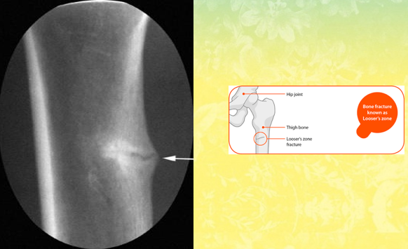 KNOWLEDGE: OSTEOMALASIA DAN RAKITIS