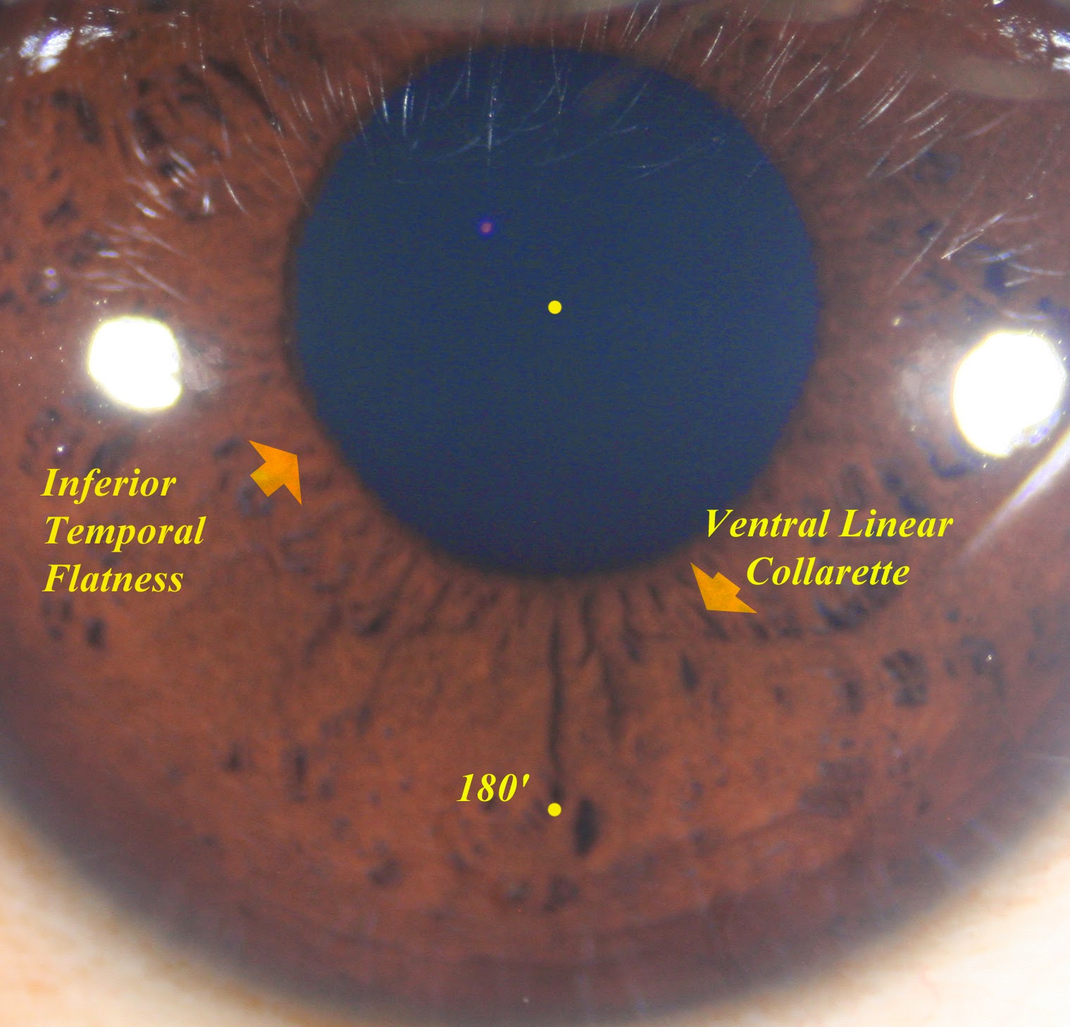 Modern & Multidimensional Iridology: Inferior Temporal Flatness, Radial ...