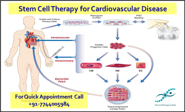 Plan Your Stem Cell Therapy for Cardiovascular Disorder in India - Stem ...