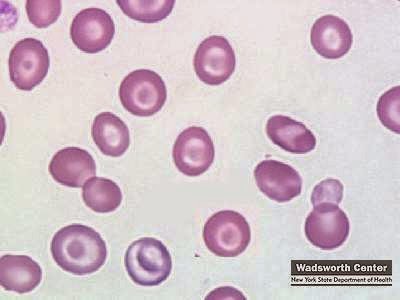 Laboratorio Clínico: Morfología anormal de los eritrocitos.