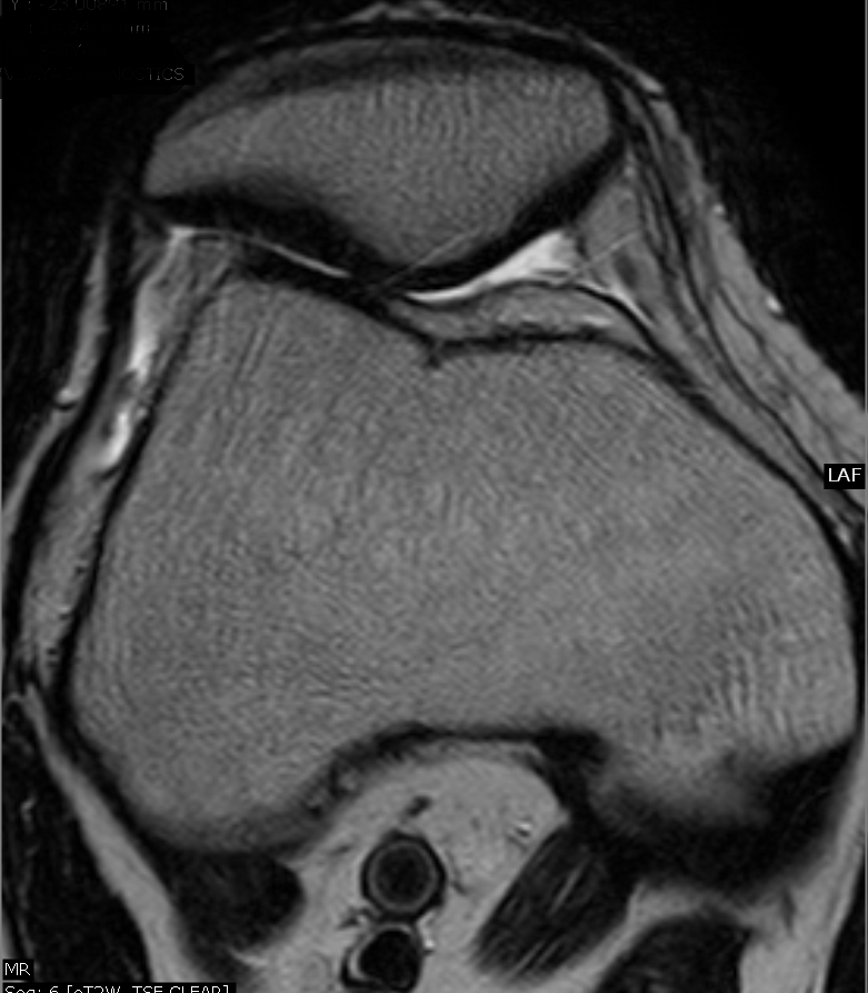 Excessive lateral pressure syndrome-MRI - Sumer's Radiology Blog