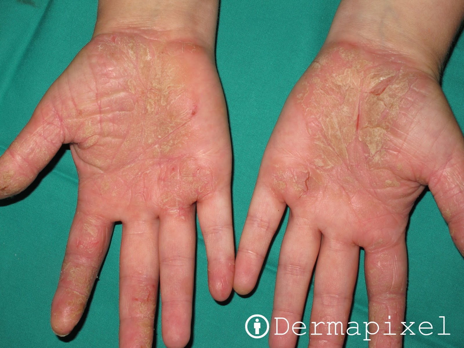 Dermapixel: diciembre 2011