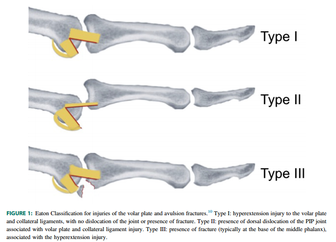 Cirugía de Mano: Manejo lesiones por trauma en hiperextension de art IFP