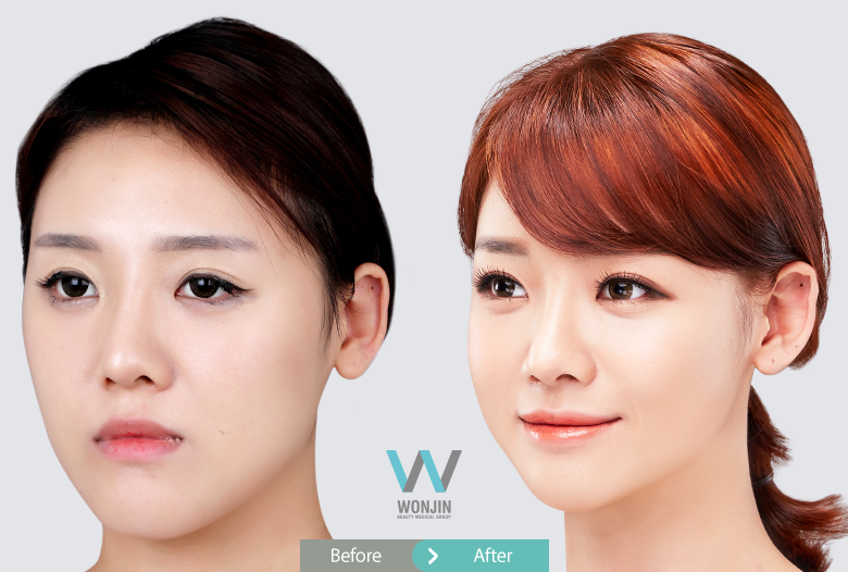 Perbedaan antara operasi dua rahang dan rahang? Operasi apa yang cocok ...