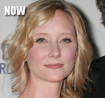 Anne Heche Plastic Surgery Before and After Facelift and Nose Job ...