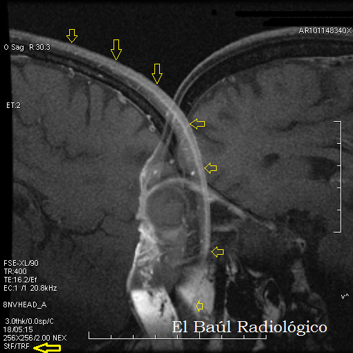 El Baúl Radiológico: ARTEFACTOS POR SUPERPOSICIÓN EN EL SENTIDO DE LA ...