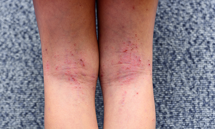 COMMON SKIN RASHES IN DERMATOLOGY PRACTICE