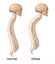 Fisioterapia: um novo modo de vida!: Desvios Posturais da Coluna Vertebral