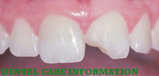 DENTAL CARE INFORMATION: Types Of Dental Teeth Fractures